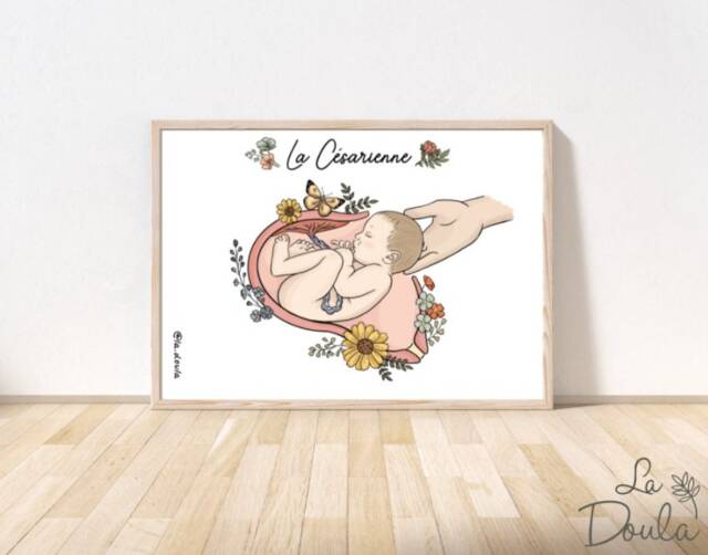 Poster Caesarean Section/Hospital, Childbirth, Surgery, Birth ...